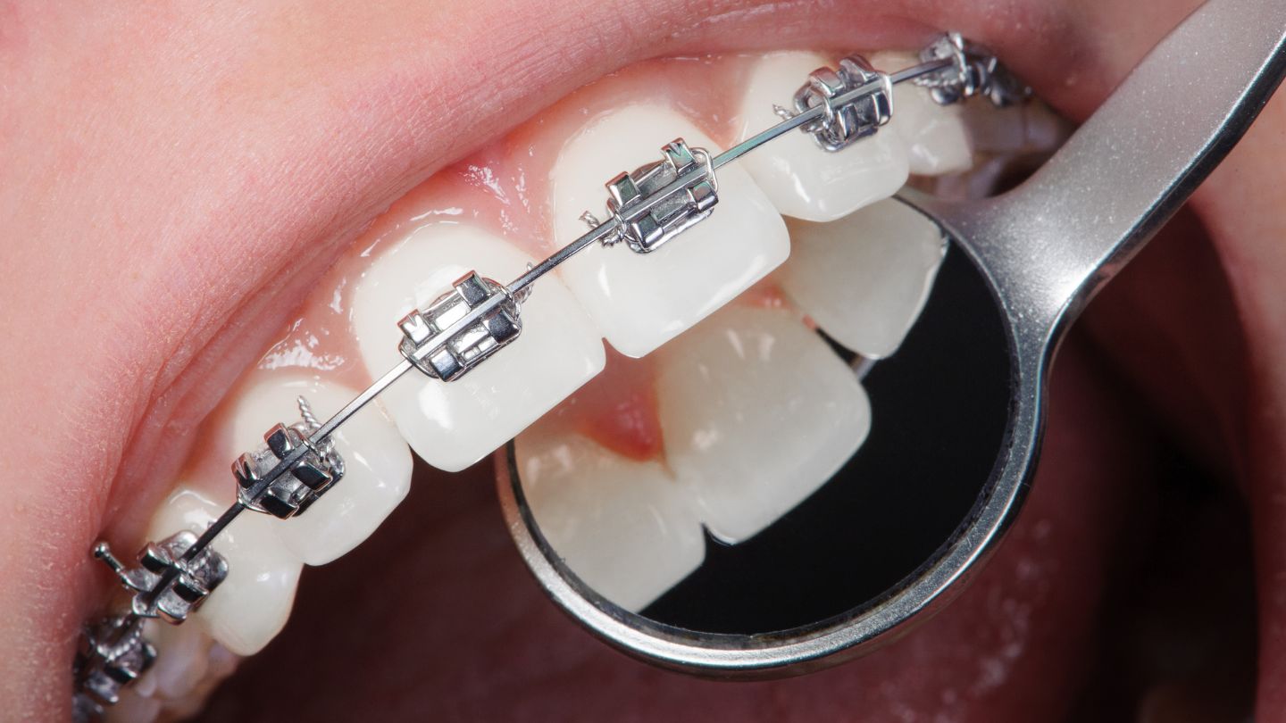 Fast Braces - Ararat Dental